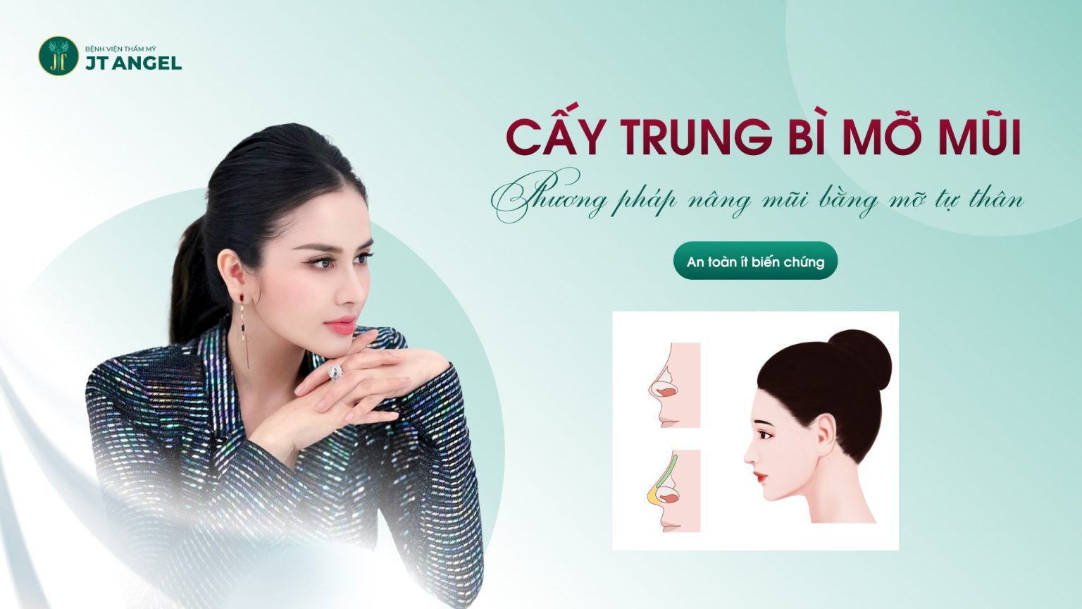 Cấy trung bì mỡ mũi: Phương pháp nâng mũi bằng mỡ tự thân an toàn ít biến chứng