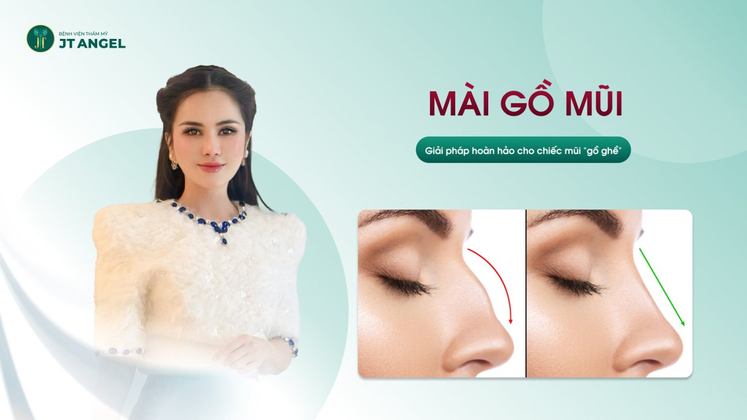 Nâng mũi - Bệnh viện thẩm mỹ JT ANGEL