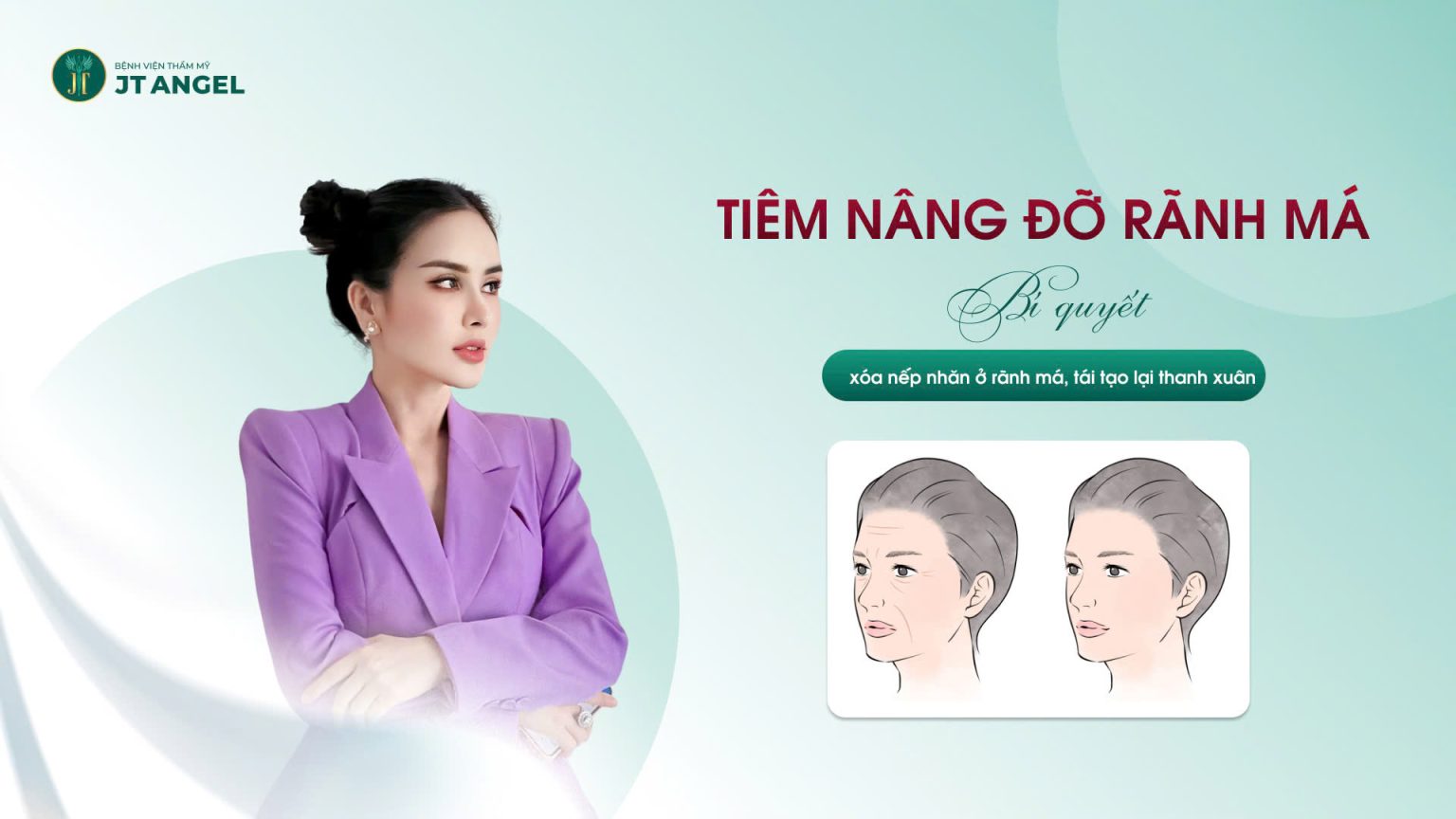 Tiêm nâng đỡ rãnh má: Bí quyết xóa nếp nhăn ở rãnh má, tái tạo lại ...