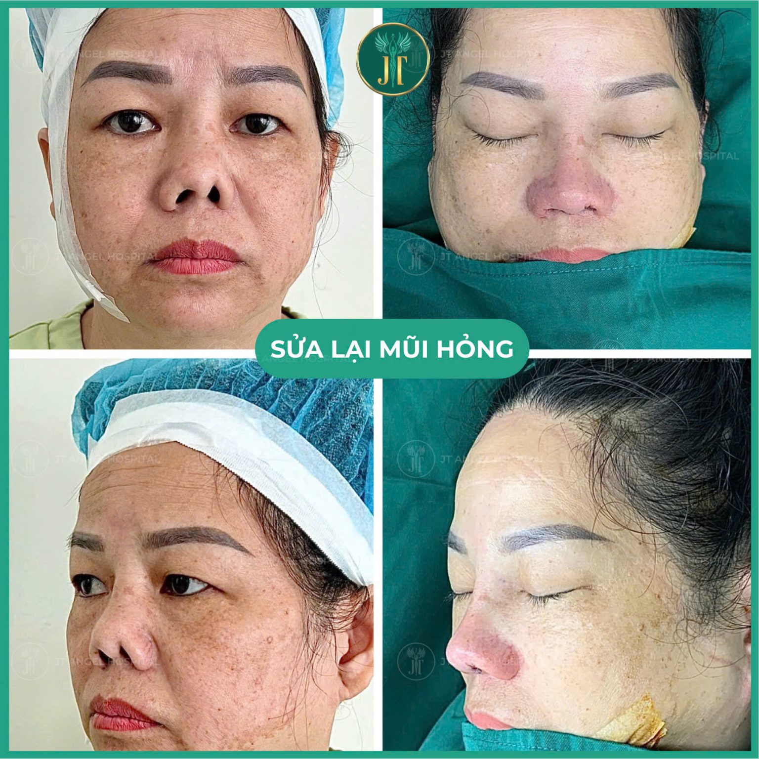 Hình ảnh trước sau tháo sụn mũi: Hiểu rõ để đưa ra quyết định đúng đắn