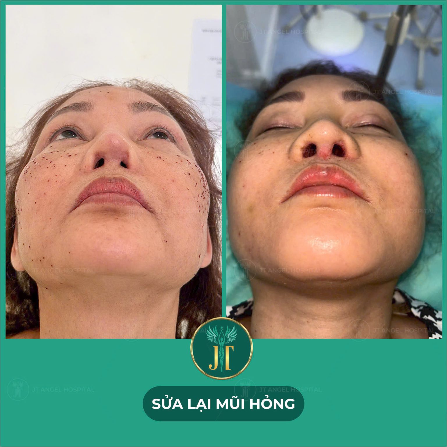Hình ảnh trước sau tháo sụn mũi: Hiểu rõ để đưa ra quyết định đúng đắn