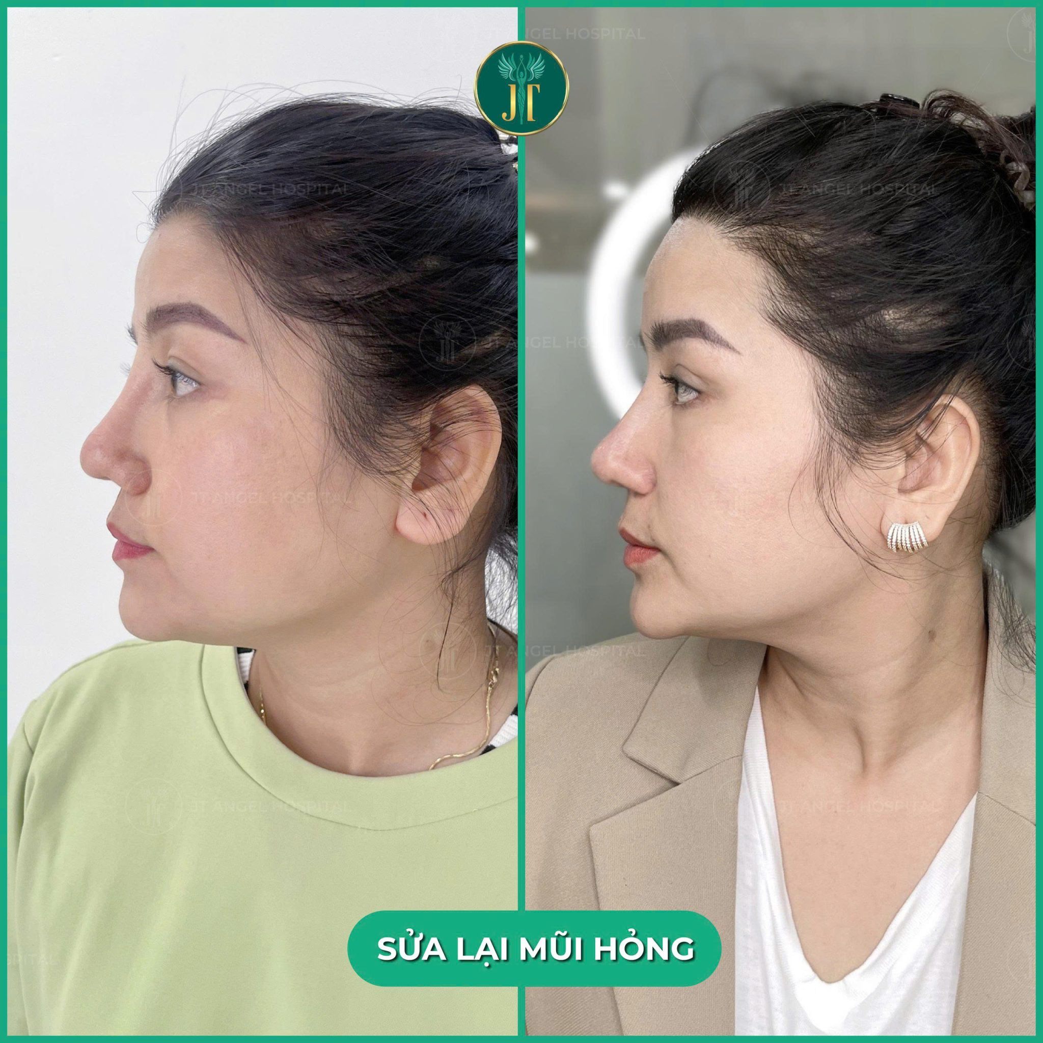 Hình ảnh trước sau tháo sụn mũi: Hiểu rõ để đưa ra quyết định đúng đắn